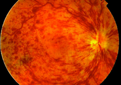 Oclusión Vena Central de la Retina (OVCR) - Proyecto MacheteProyecto ...